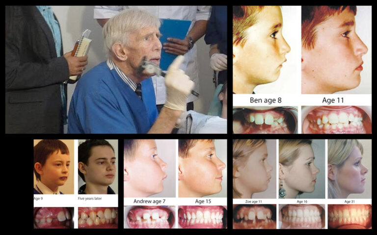 Crooked teeth, mewing, snoring, & Mike Tyson's neck — Outlive